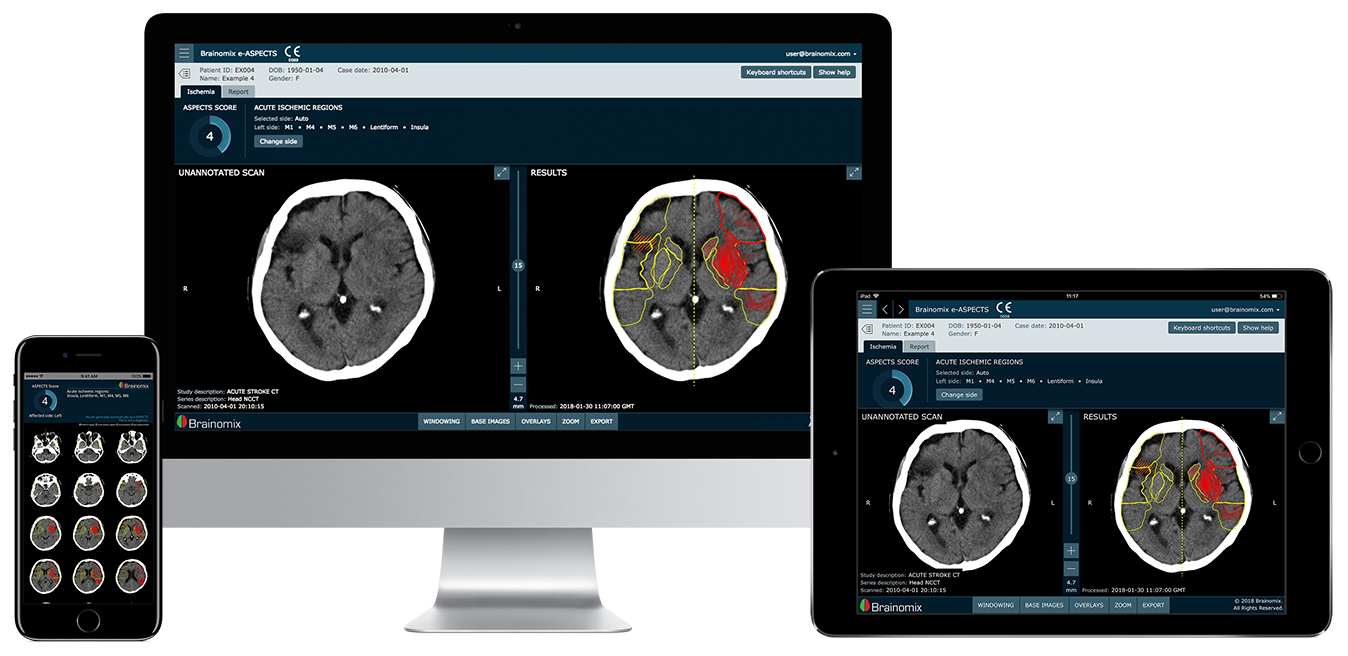 Oxford spinout Brainomix secures £7m investment to tackle strokes with ...